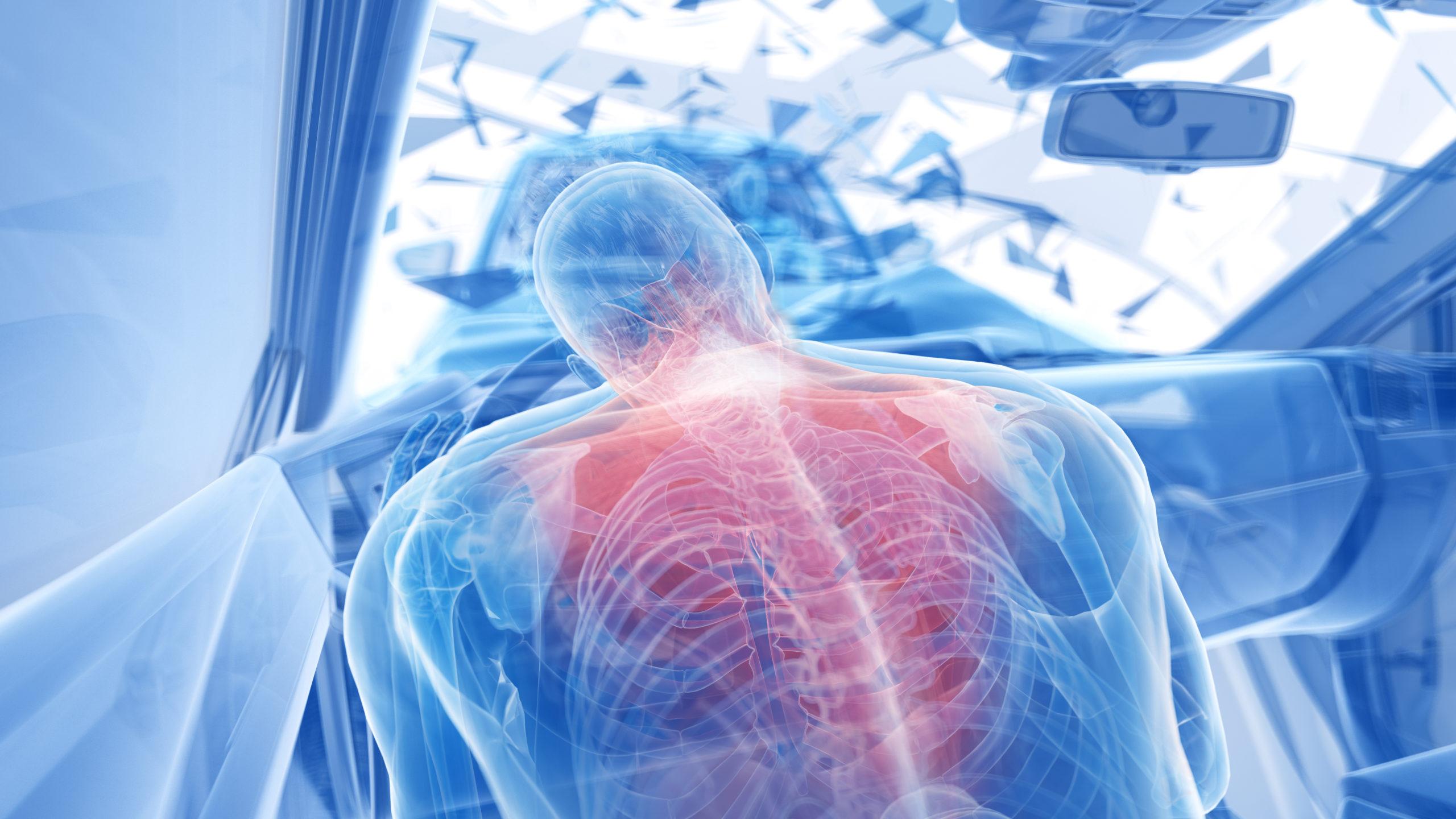 How To Fake Back Injury From Car Accident at Debra Baughman blog