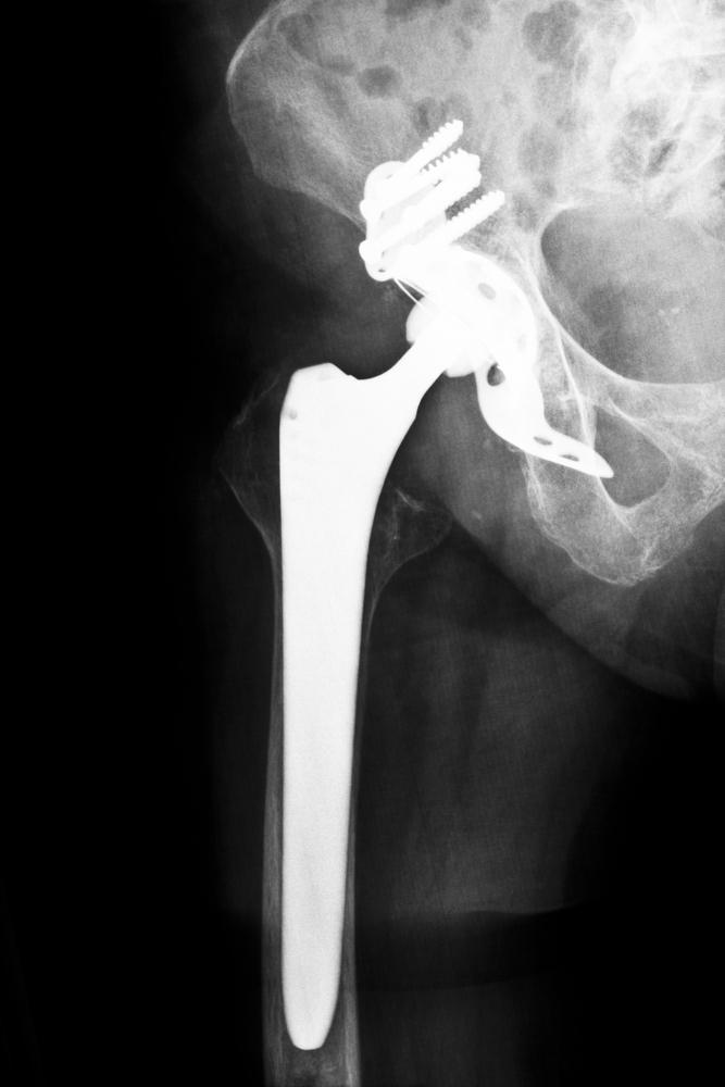 New Orleans DePuy Hip Recall Lawyers | Morris Bart, LLC