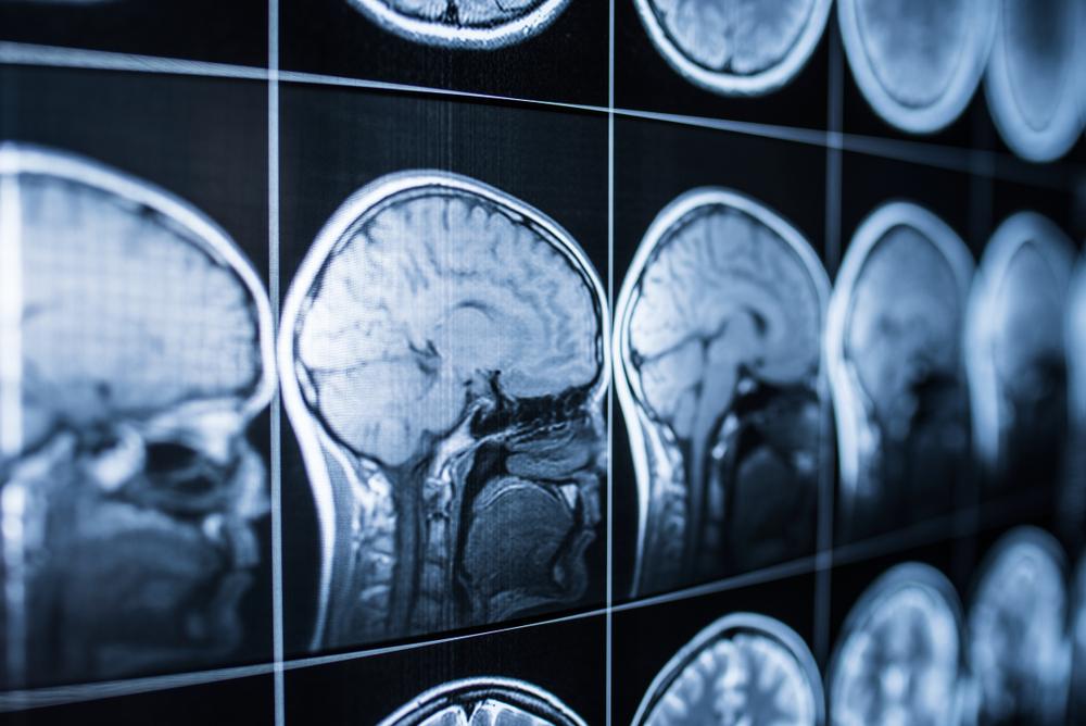 Which Accidents Can Lead to Brain Injuries? | Morris Bart, LLC
